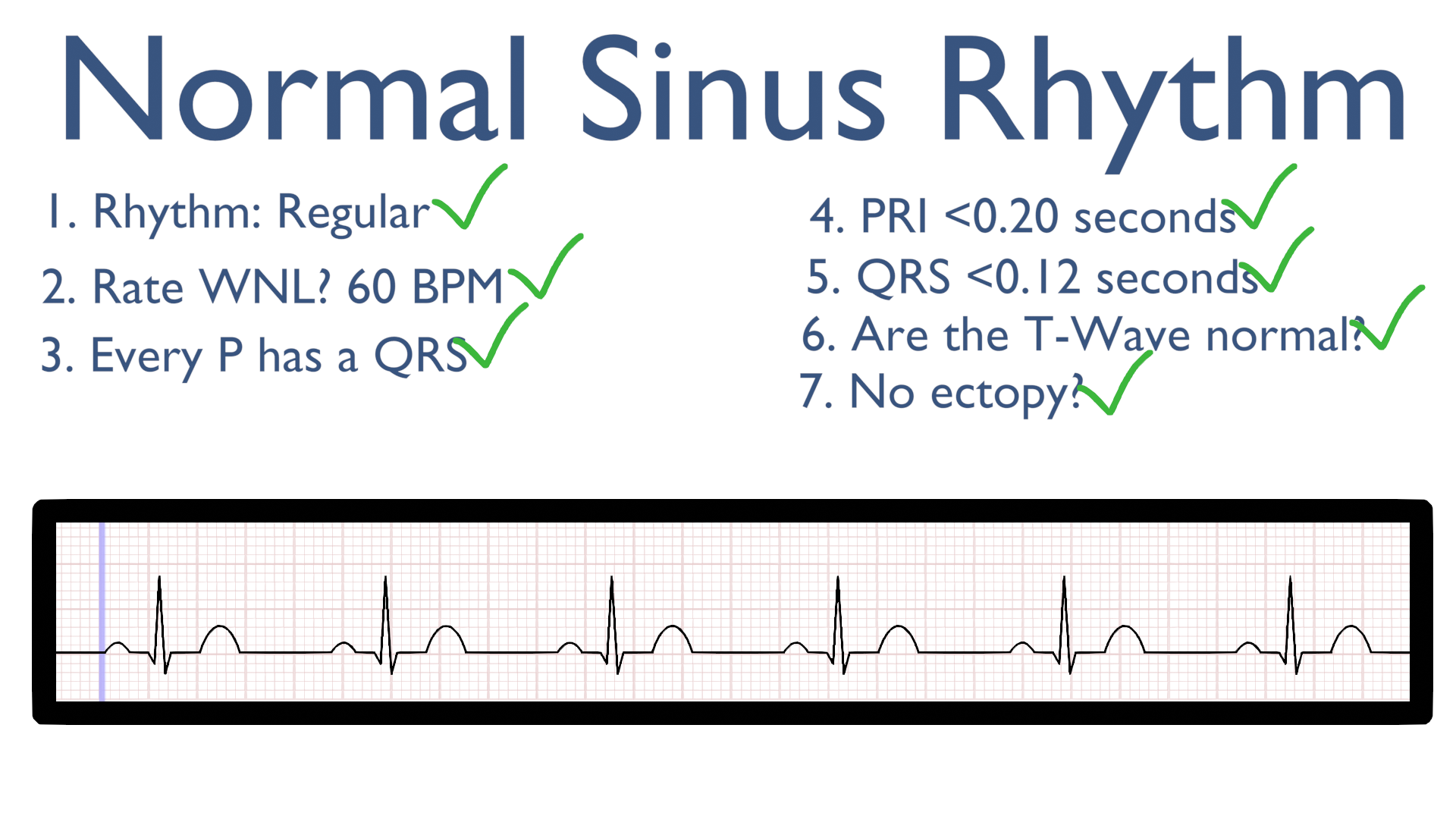 Normal Sinus Rhythm (NSR) – Nursing Unraveled