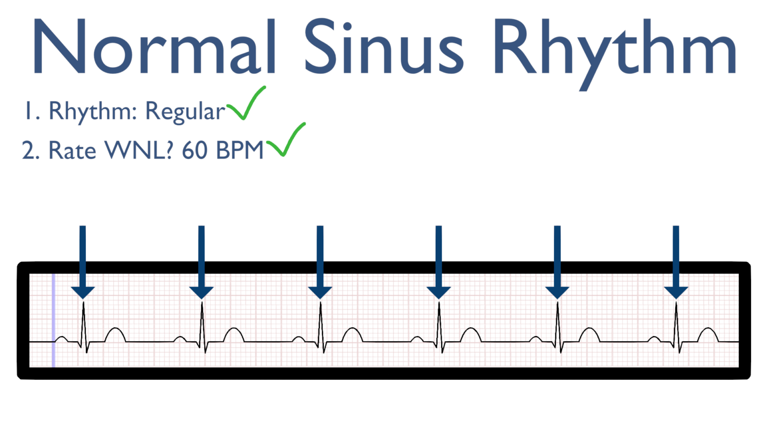 Normal Sinus Rhythm (NSR) – Nursing Unraveled