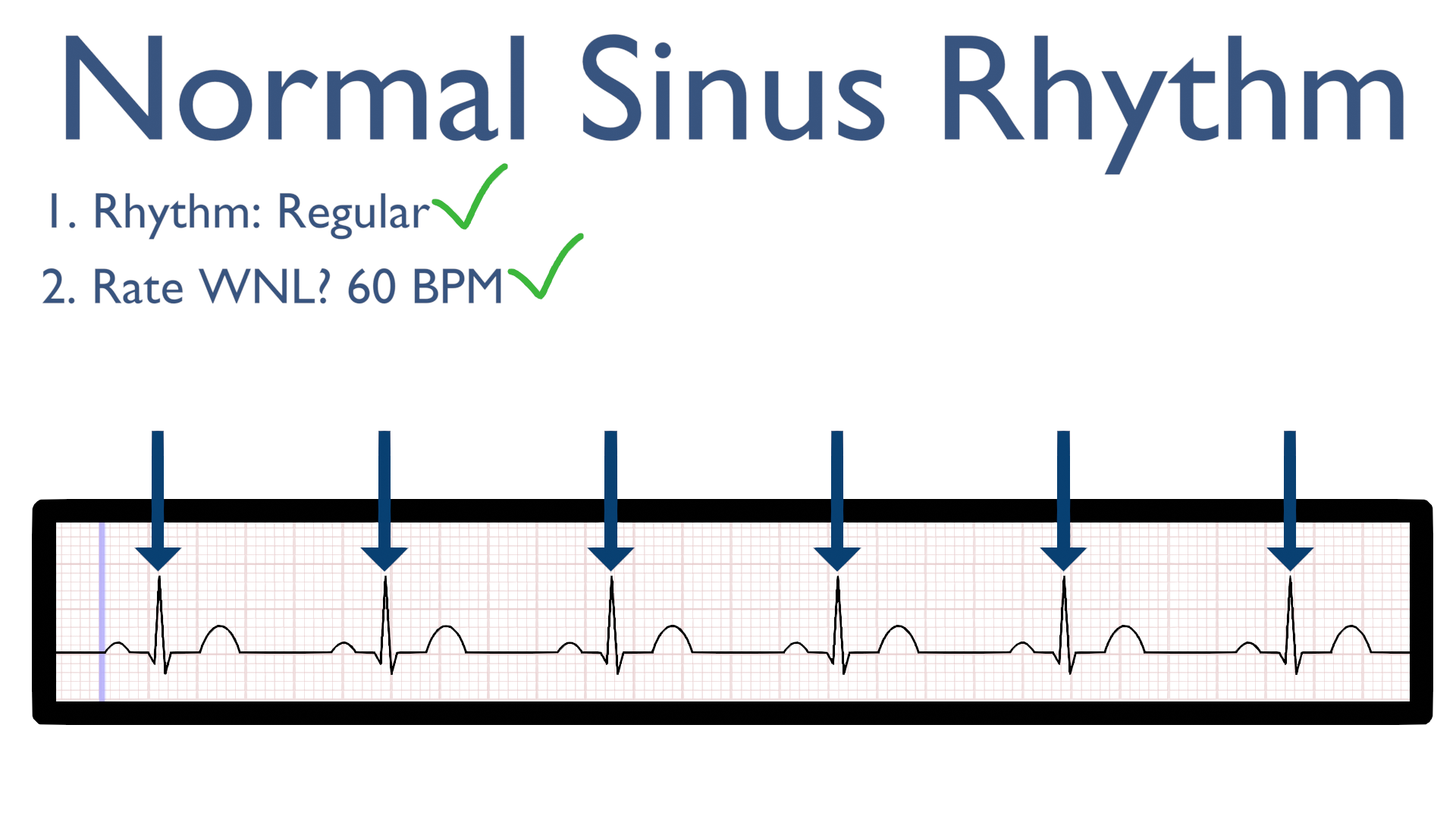 Normal Sinus Rhythm (NSR) – Nursing Unraveled
