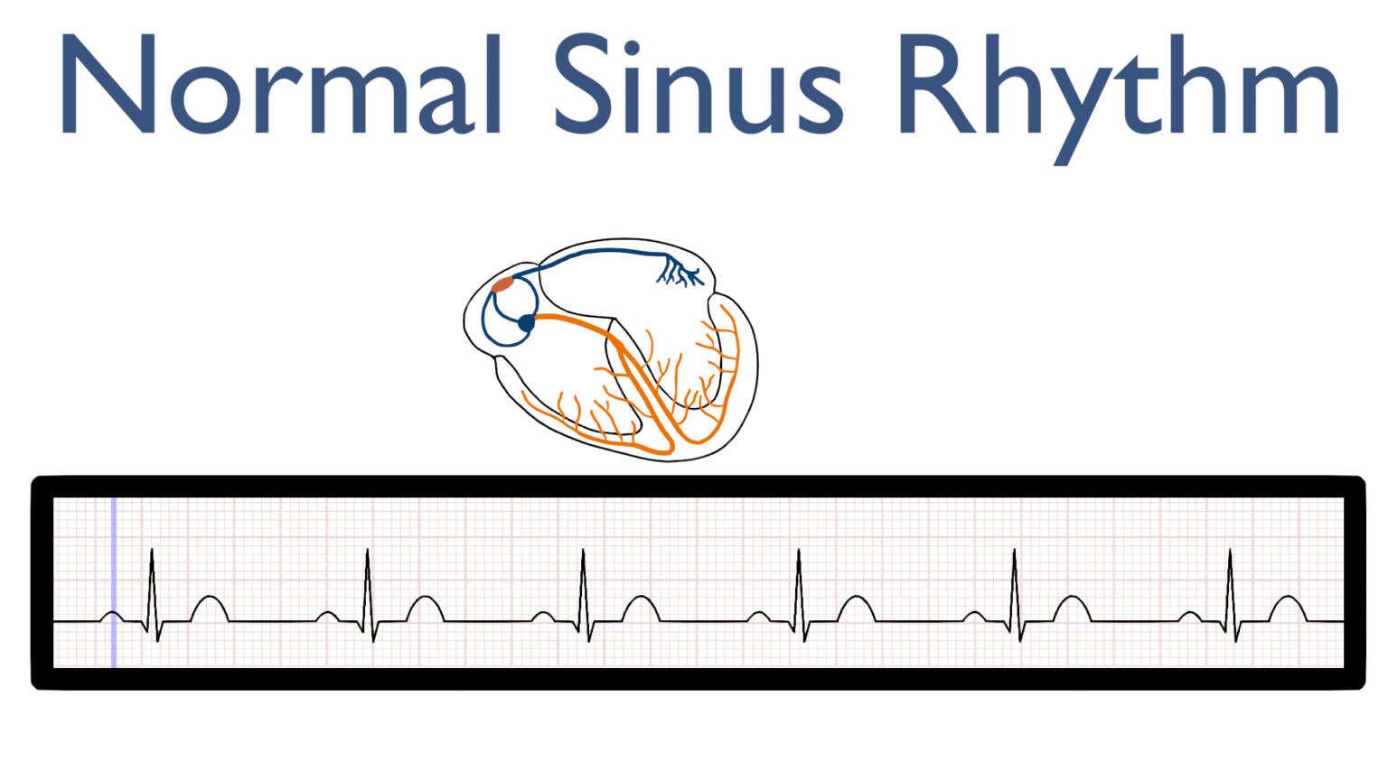Normal Sinus Rhythm (NSR) – Nursing Unraveled