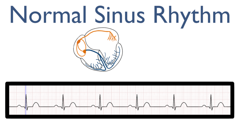 Normal Sinus Rhythm (NSR) – Nursing Unraveled