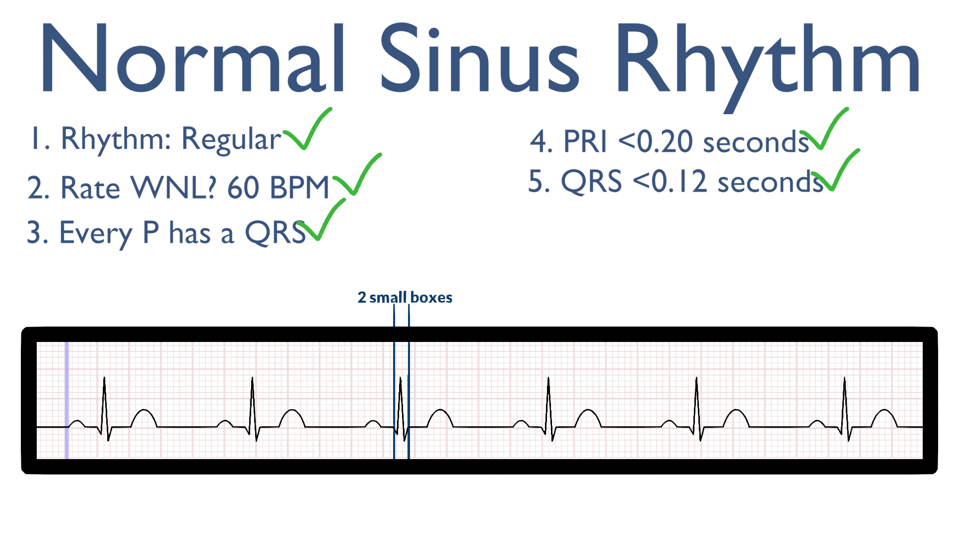 Normal Sinus Rhythm (NSR) – Nursing Unraveled