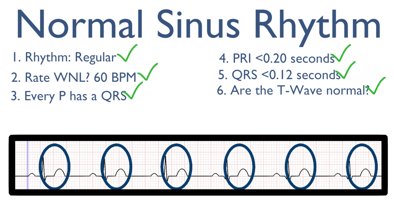 Normal Sinus Rhythm (NSR) – Nursing Unraveled