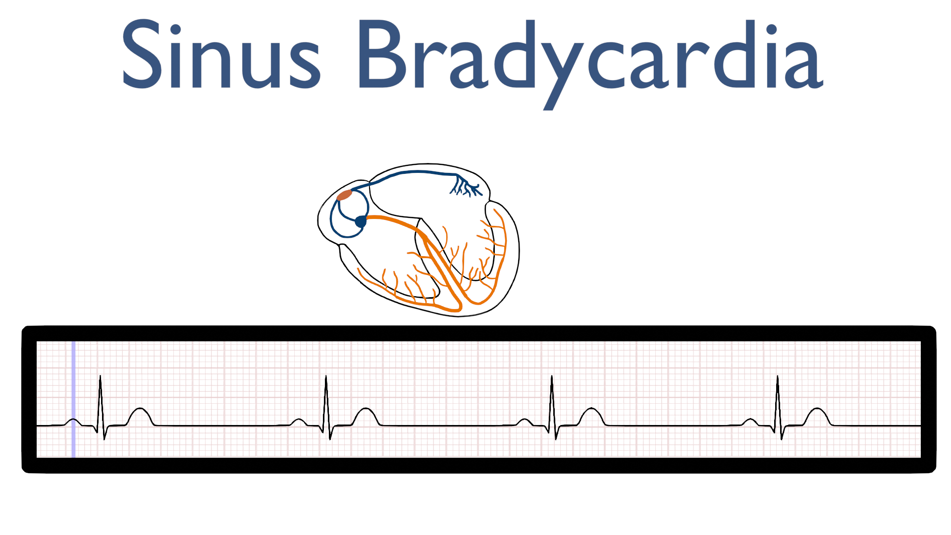 Sinus Bradycardia – Nursing Unraveled