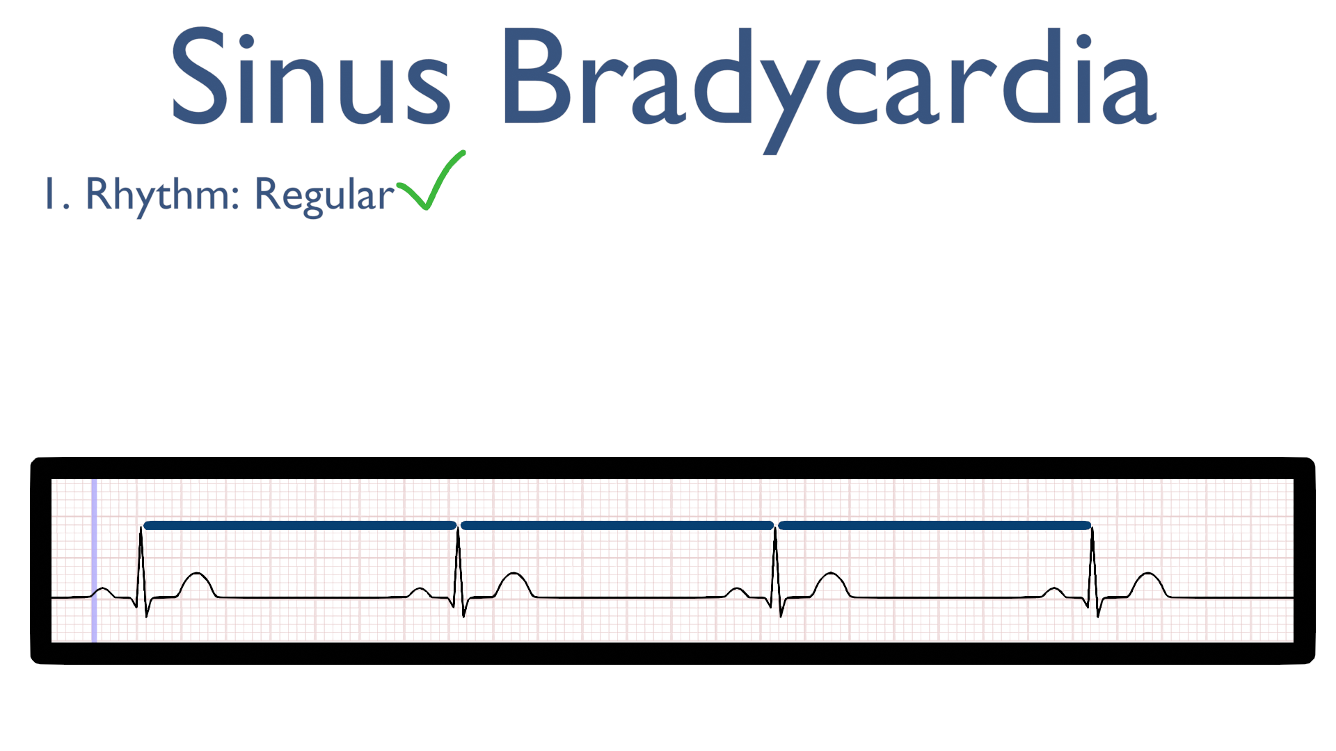 Sinus Bradycardia – Nursing Unraveled