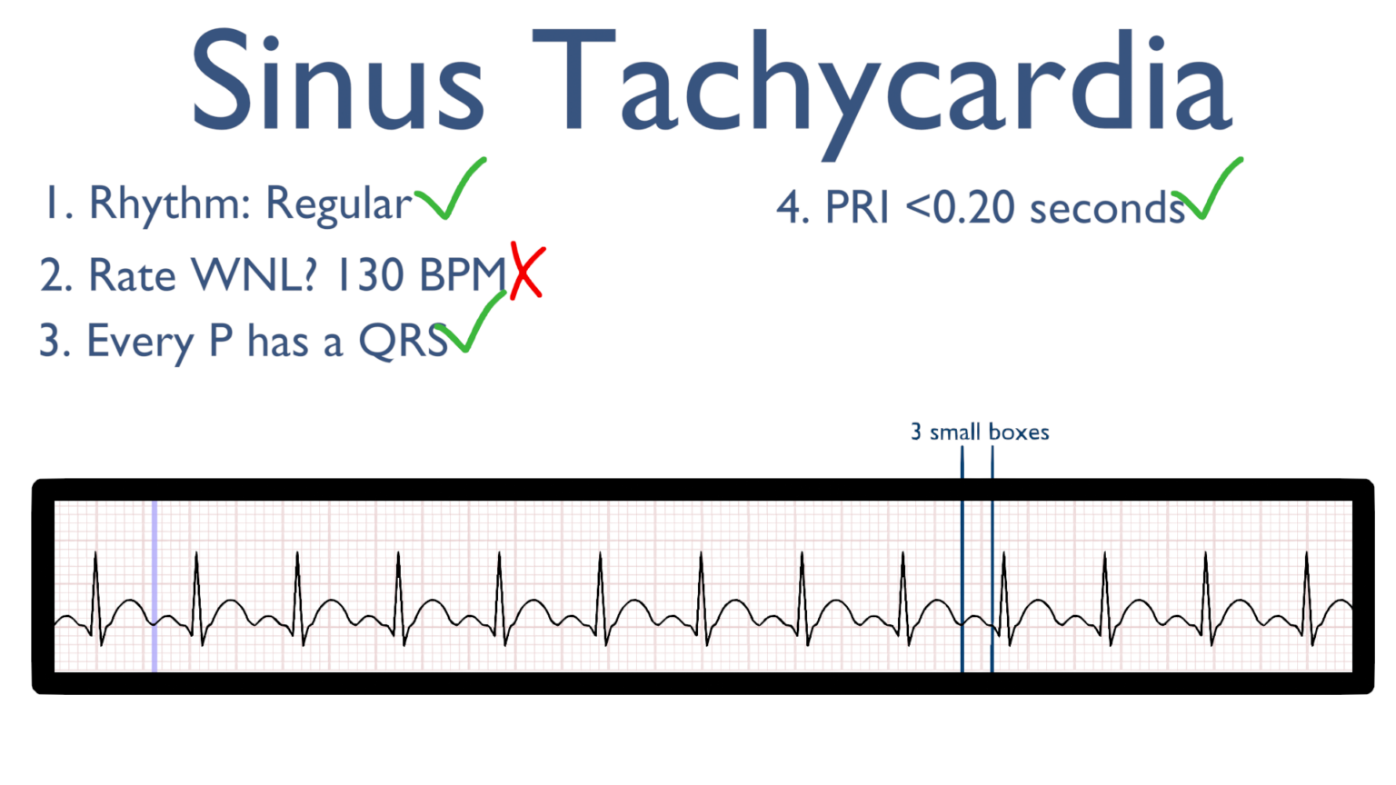 Sinus Tachycardia – Nursing Unraveled