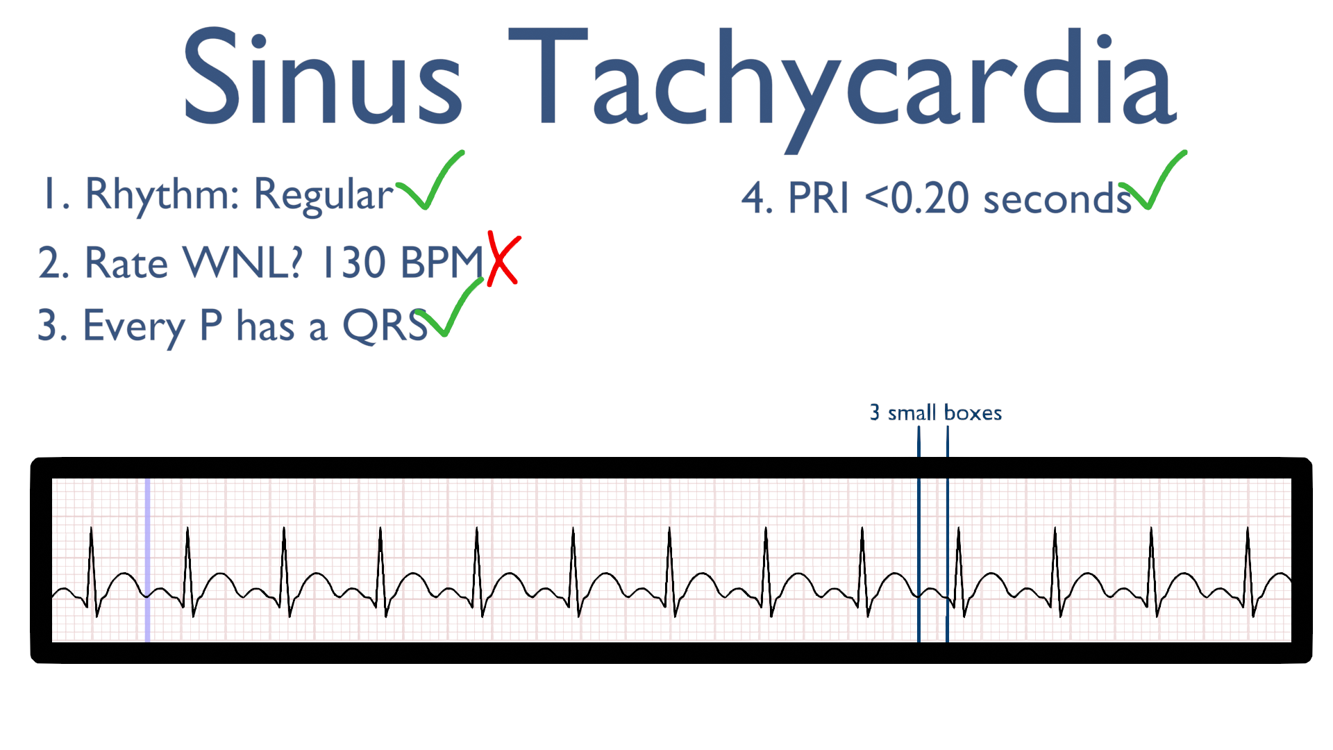 Sinus Tachycardia – Nursing Unraveled