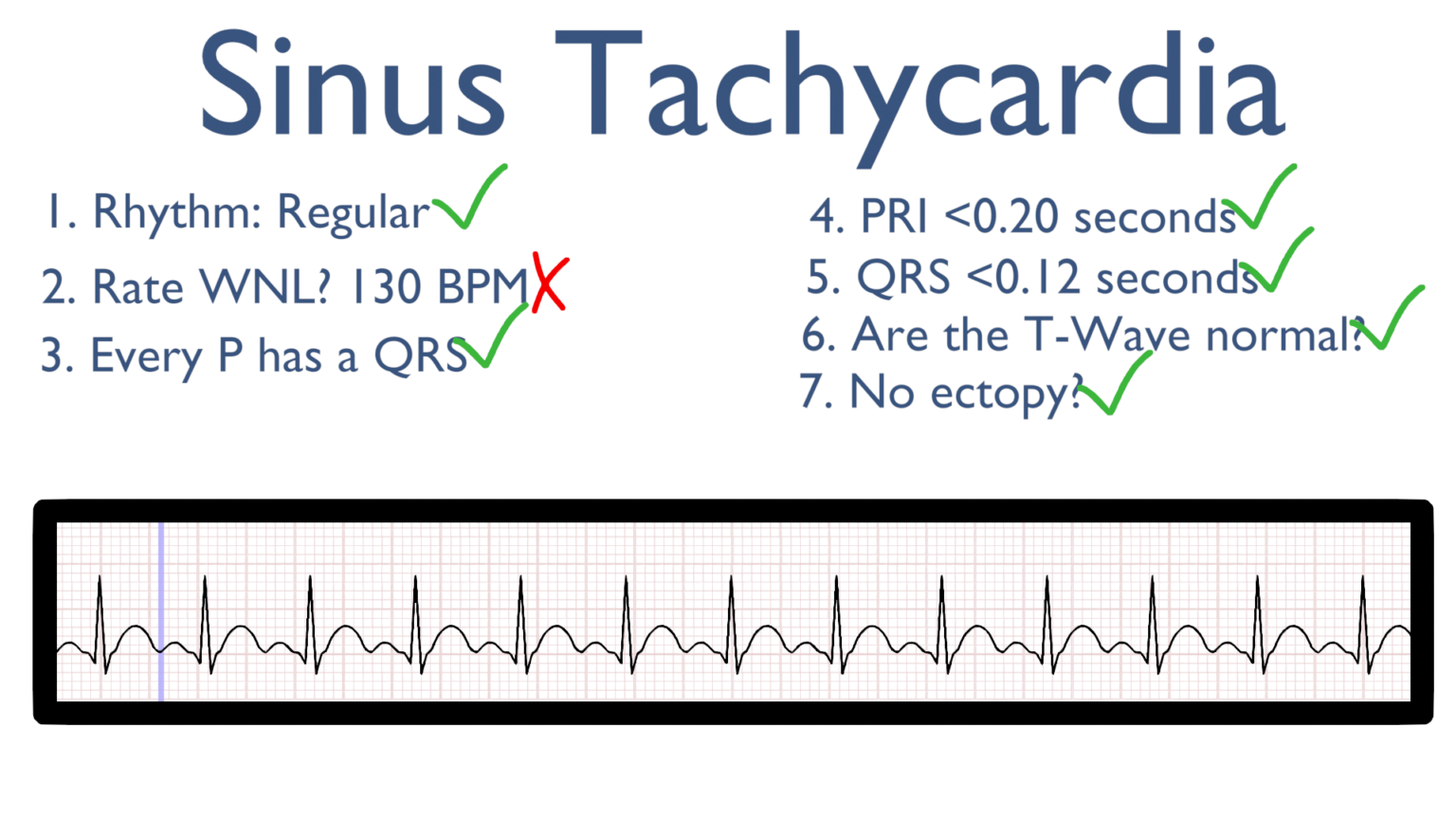 Sinus Tachycardia – Nursing Unraveled