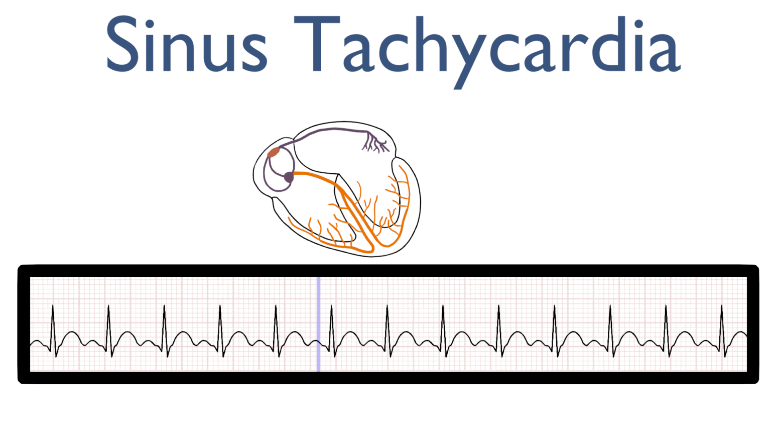 Sinus Tachycardia – Nursing Unraveled