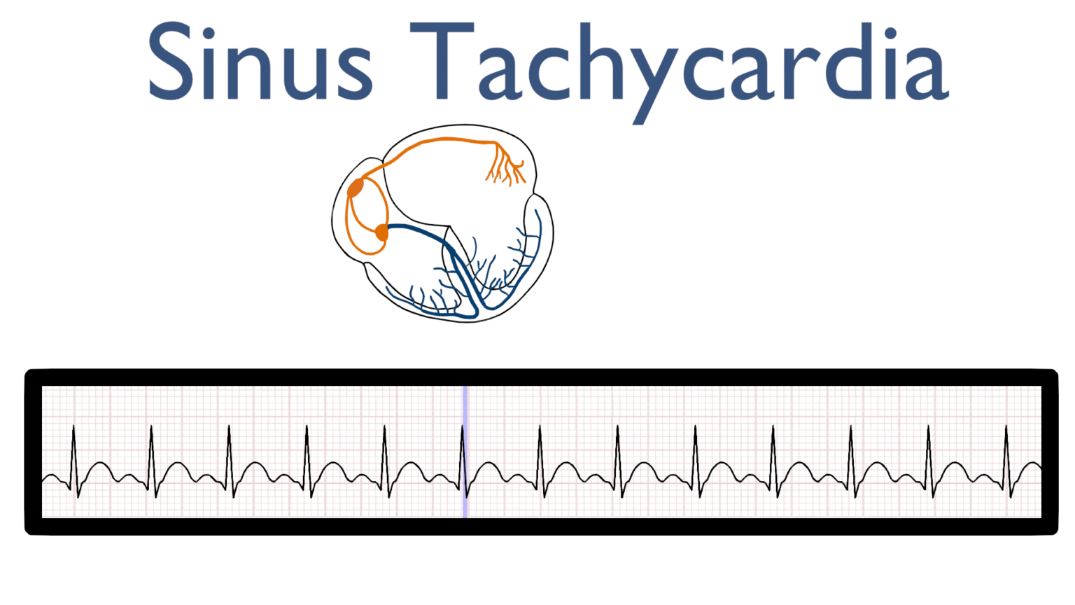 Sinus Tachycardia – Nursing Unraveled