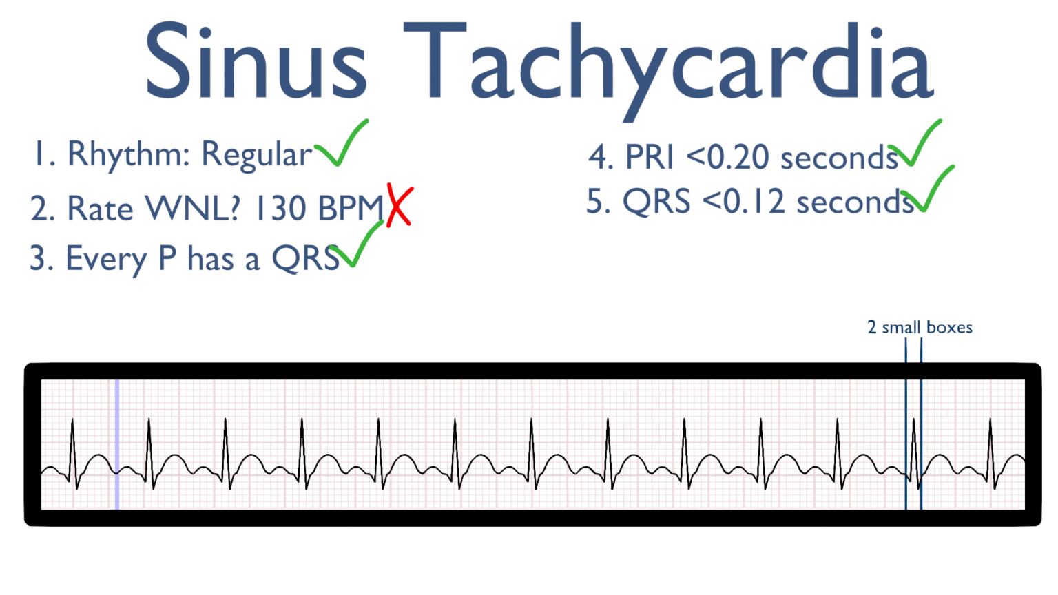 Sinus Tachycardia – Nursing Unraveled