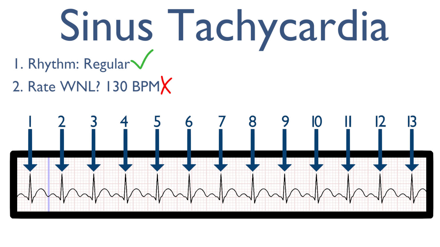 Sinus Tachycardia – Nursing Unraveled