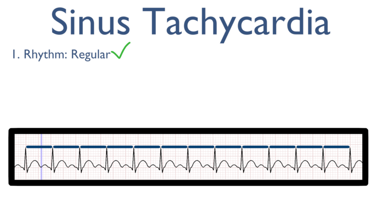 Sinus Tachycardia – Nursing Unraveled