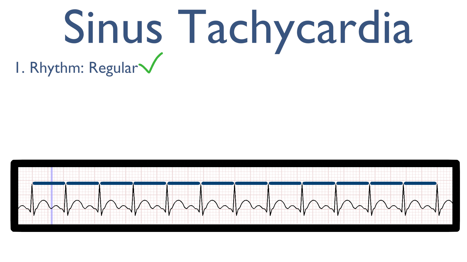 Sinus Tachycardia – Nursing Unraveled