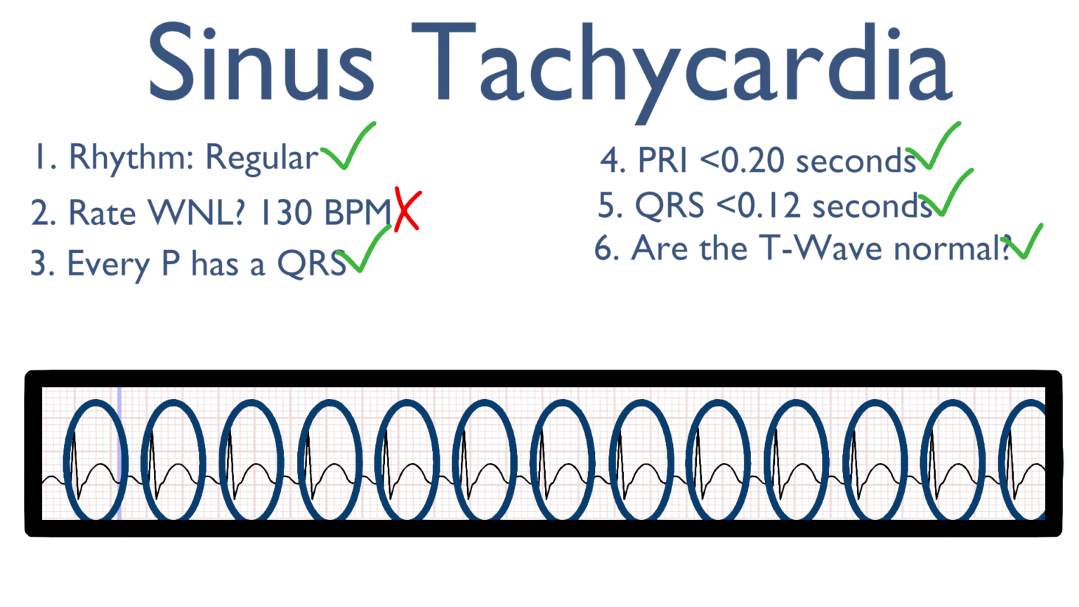 Sinus Tachycardia – Nursing Unraveled