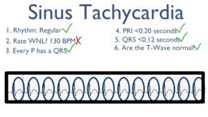 Sinus Tachycardia – Nursing Unraveled