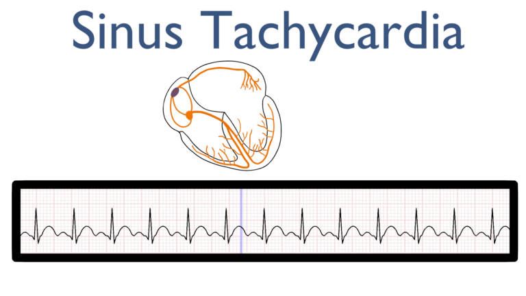 Sinus Tachycardia – Nursing Unraveled