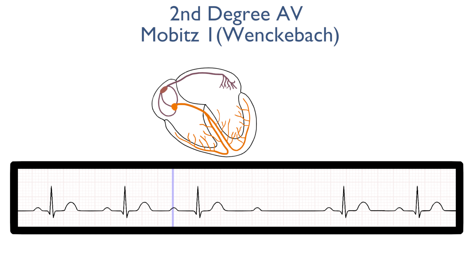 Type 2 AV Block Mobitz 1 (Wenckebach) – Nursing Unraveled