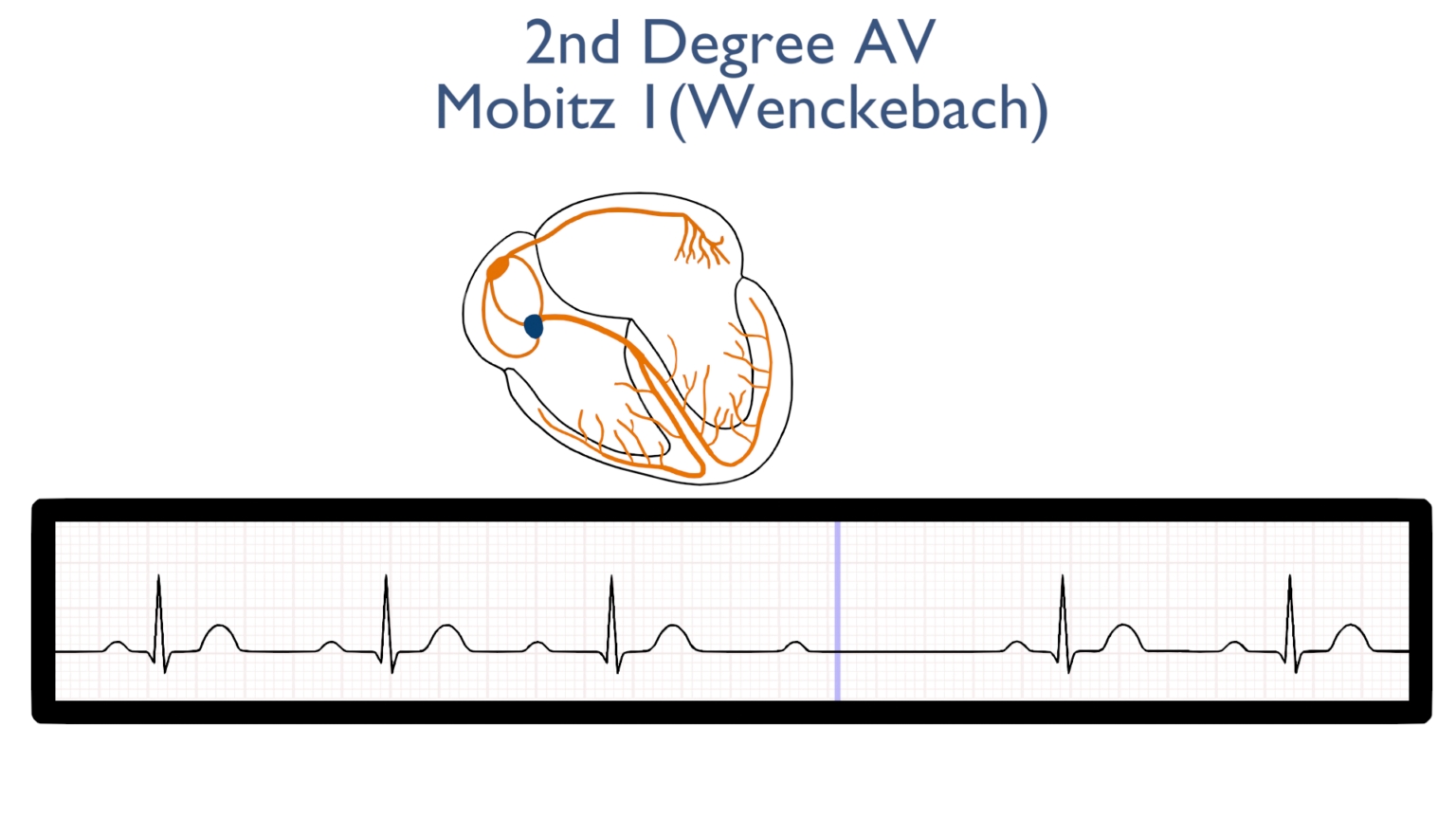 Type 2 AV Block Mobitz 1 (Wenckebach) – Nursing Unraveled