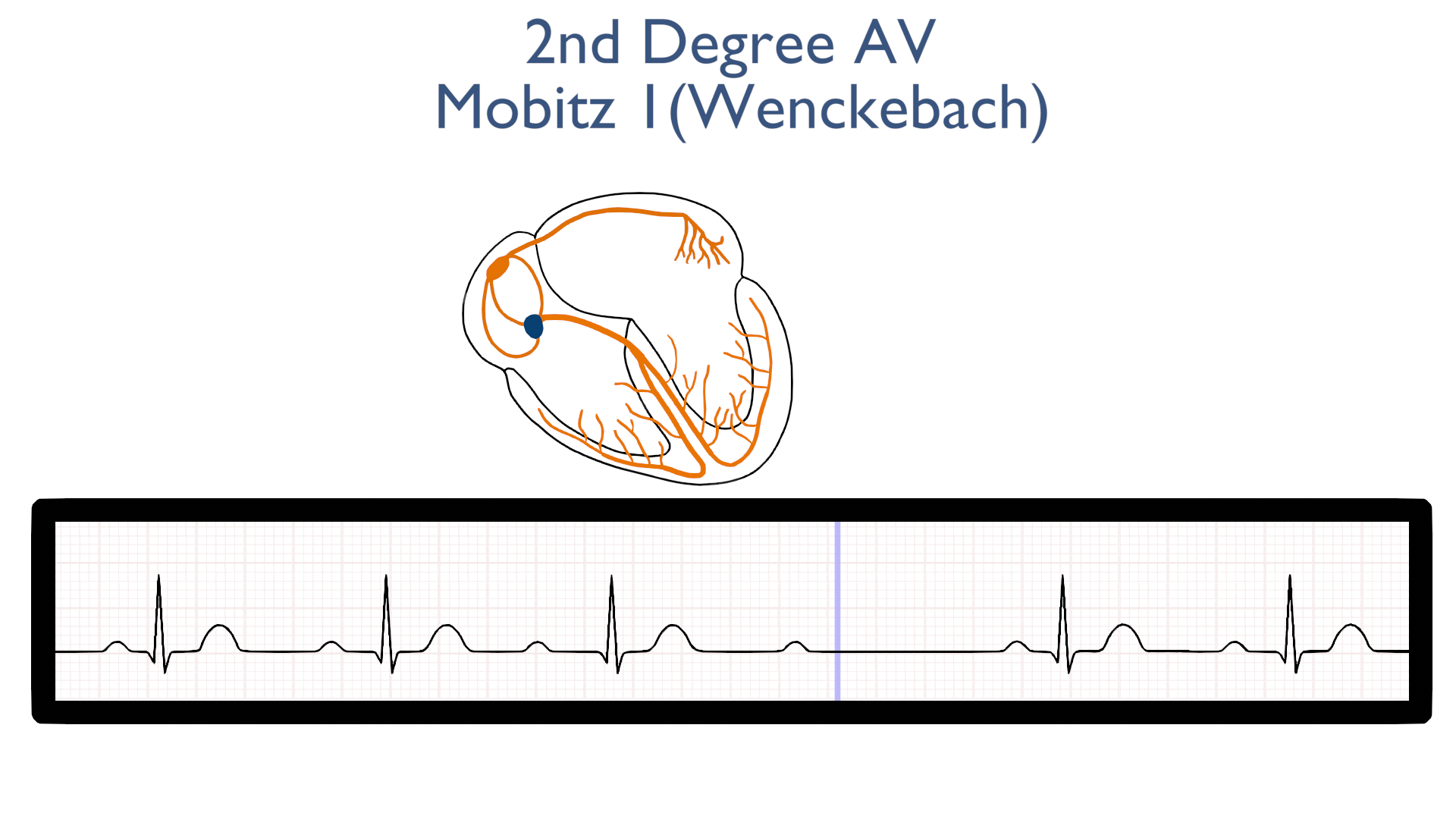 Type 2 AV Block Mobitz 1 (Wenckebach) – Nursing Unraveled