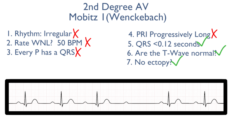 Type 2 AV Block Mobitz 1 (Wenckebach) – Nursing Unraveled