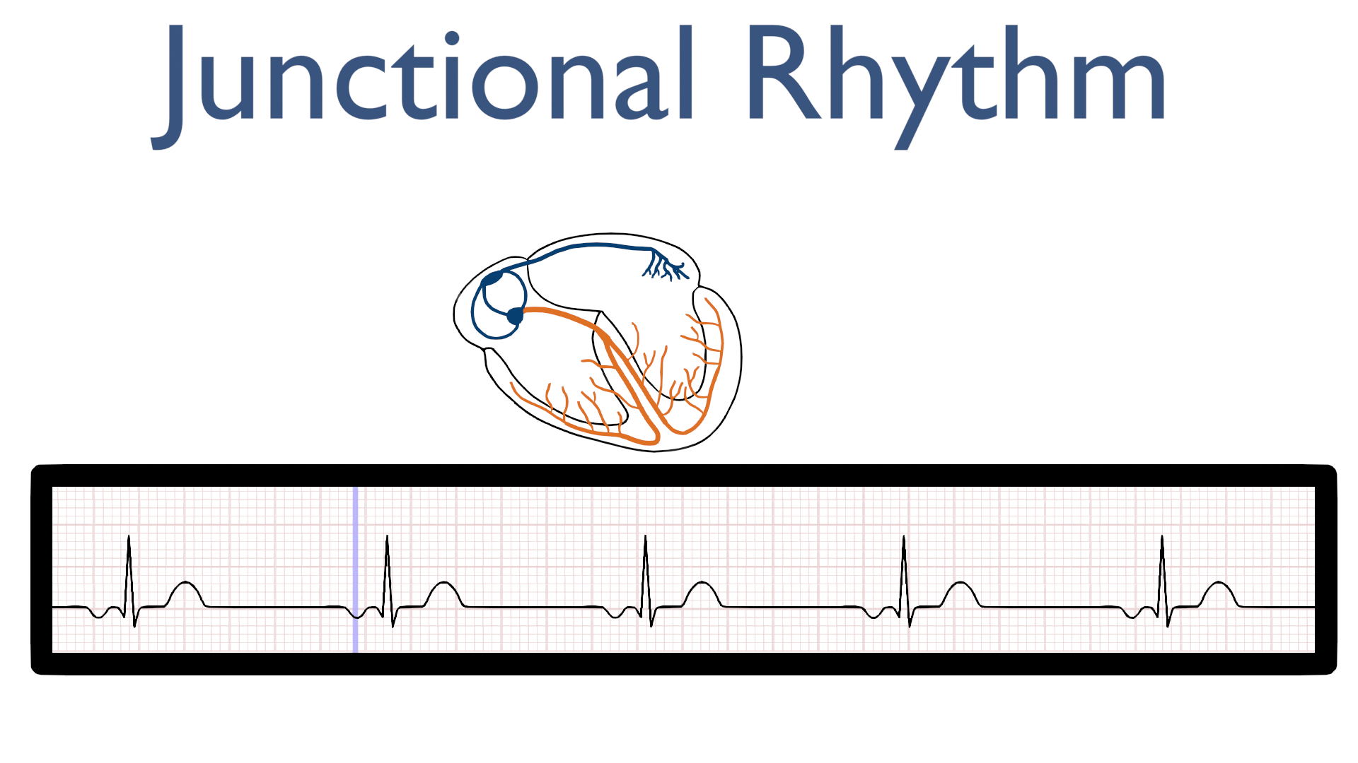 Junctional Rhythm – Nursing Unraveled