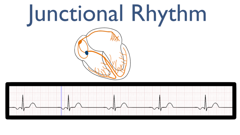 Junctional Rhythm – Nursing Unraveled