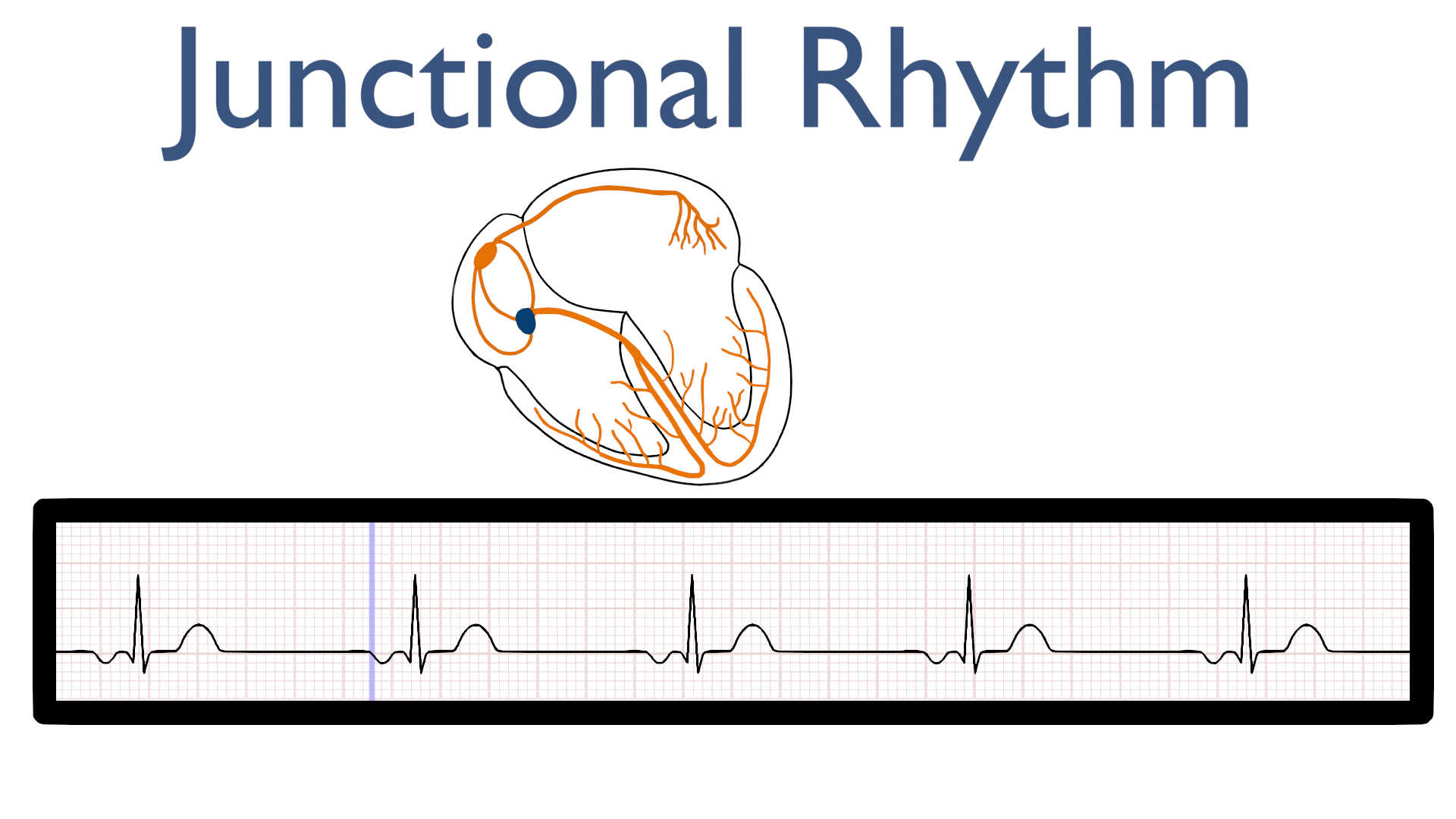 Junctional Rhythm – Nursing Unraveled