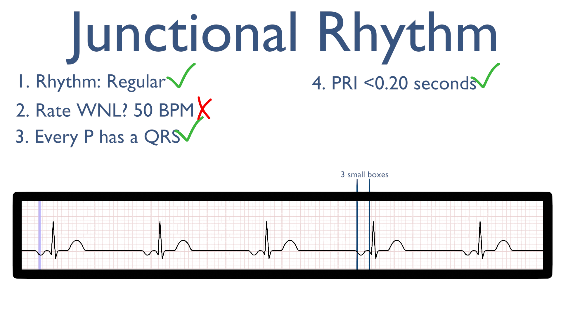 Junctional Rhythm – Nursing Unraveled