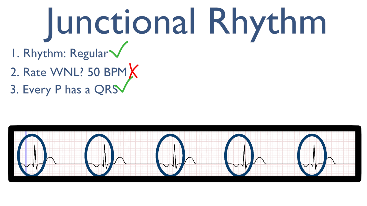 Junctional Rhythm – Nursing Unraveled