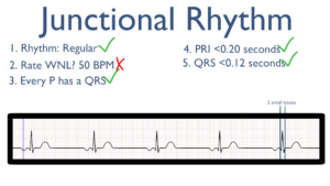 Junctional Rhythm – Nursing Unraveled