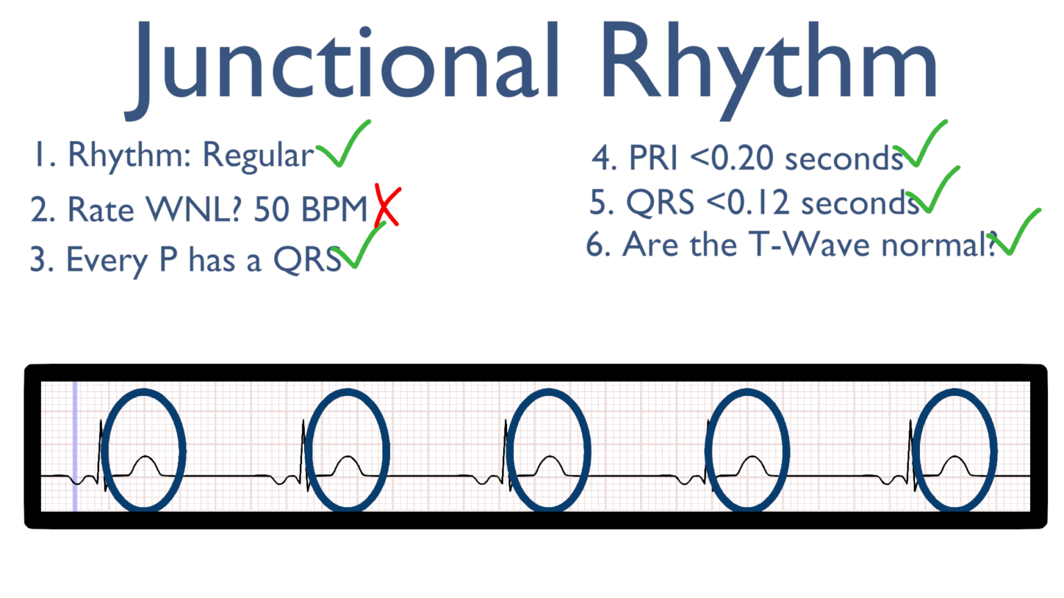 Junctional Rhythm – Nursing Unraveled