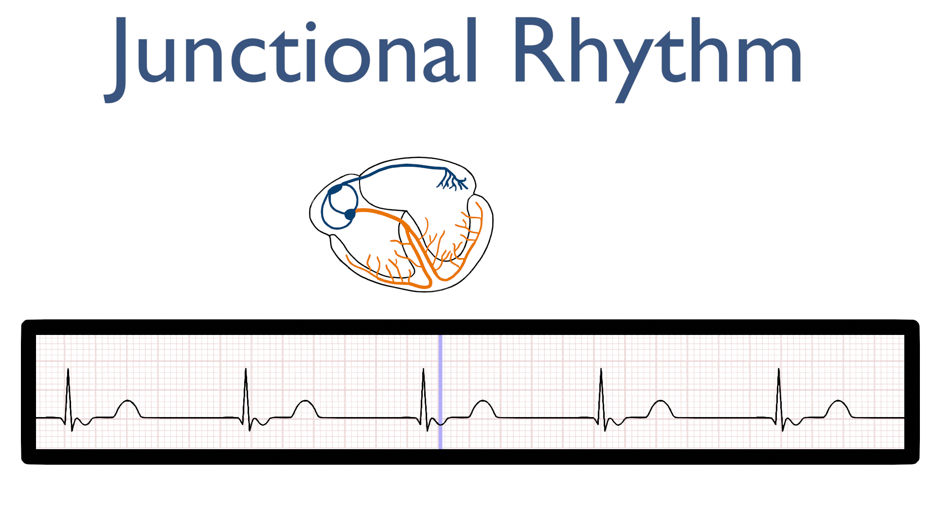 Junctional Rhythm – Nursing Unraveled
