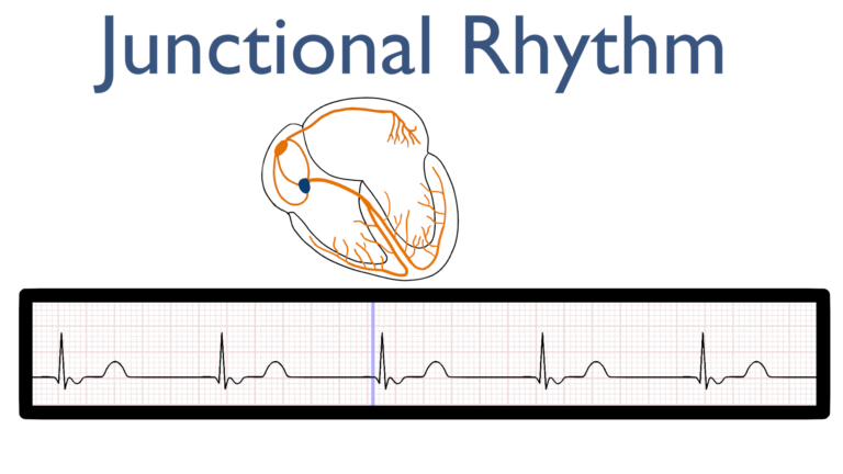 Junctional Rhythm – Nursing Unraveled