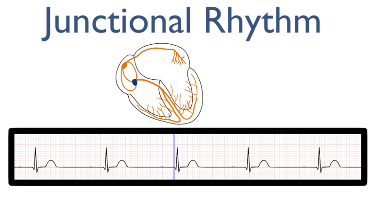 Junctional Rhythm – Nursing Unraveled