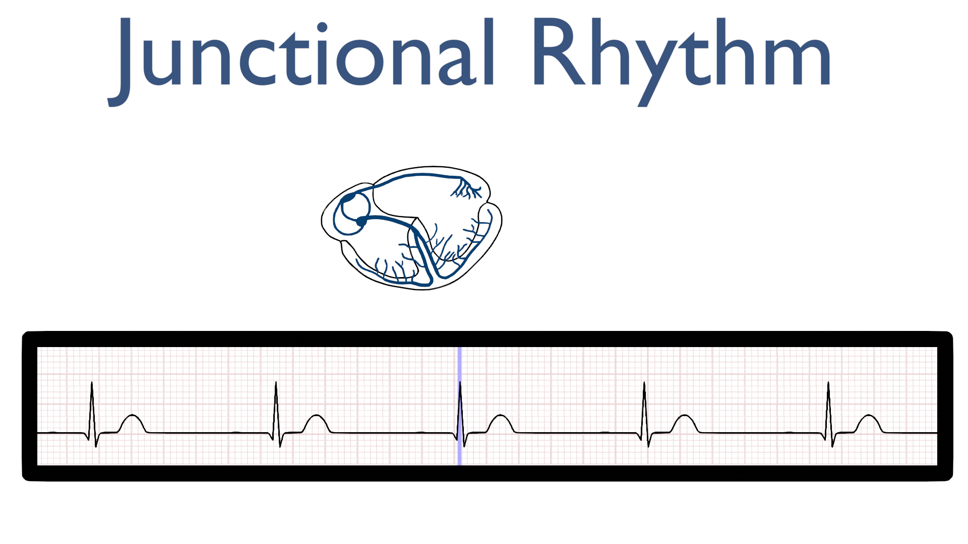 Junctional Rhythm – Nursing Unraveled