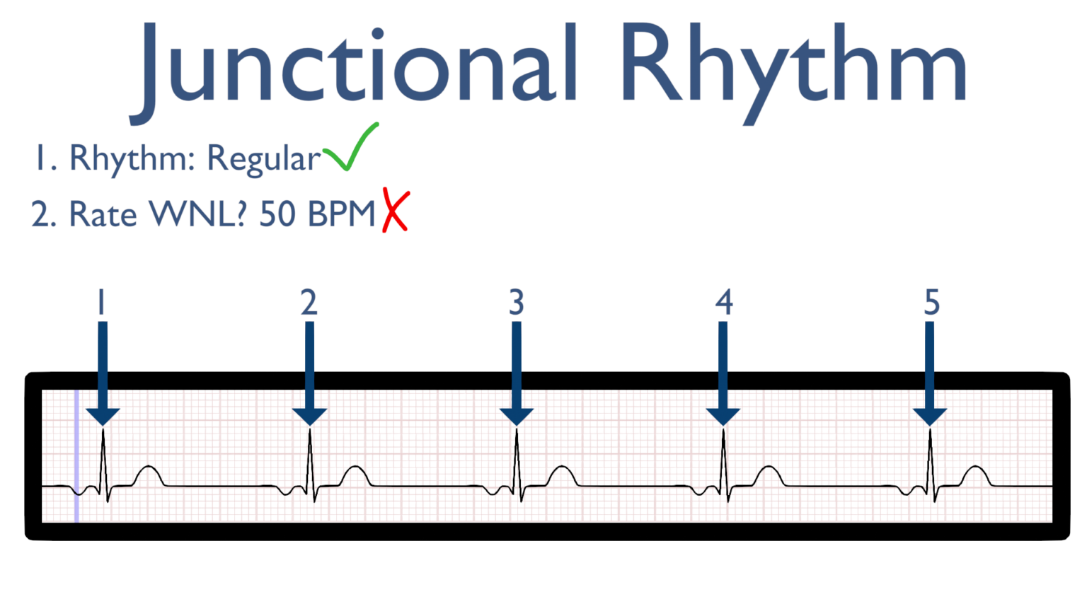 Junctional Rhythm – Nursing Unraveled