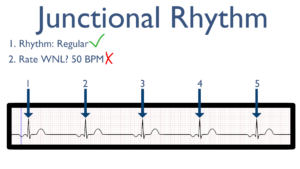 Junctional Rhythm – Nursing Unraveled