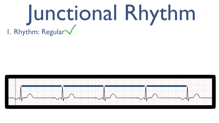 Junctional Rhythm – Nursing Unraveled