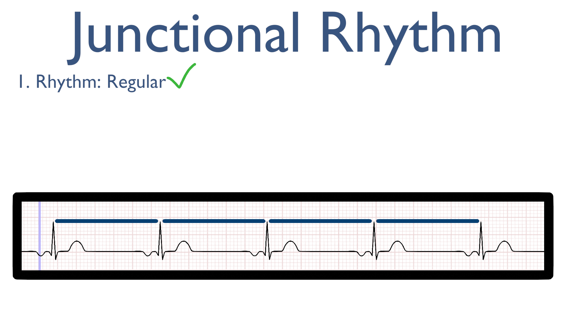 Junctional Rhythm – Nursing Unraveled