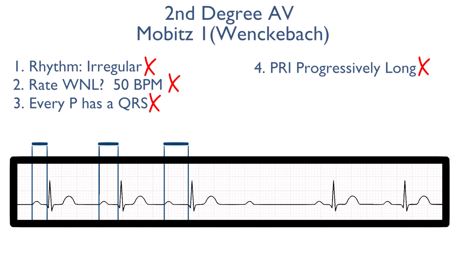 Type 2 AV Block Mobitz 1 (Wenckebach) – Nursing Unraveled