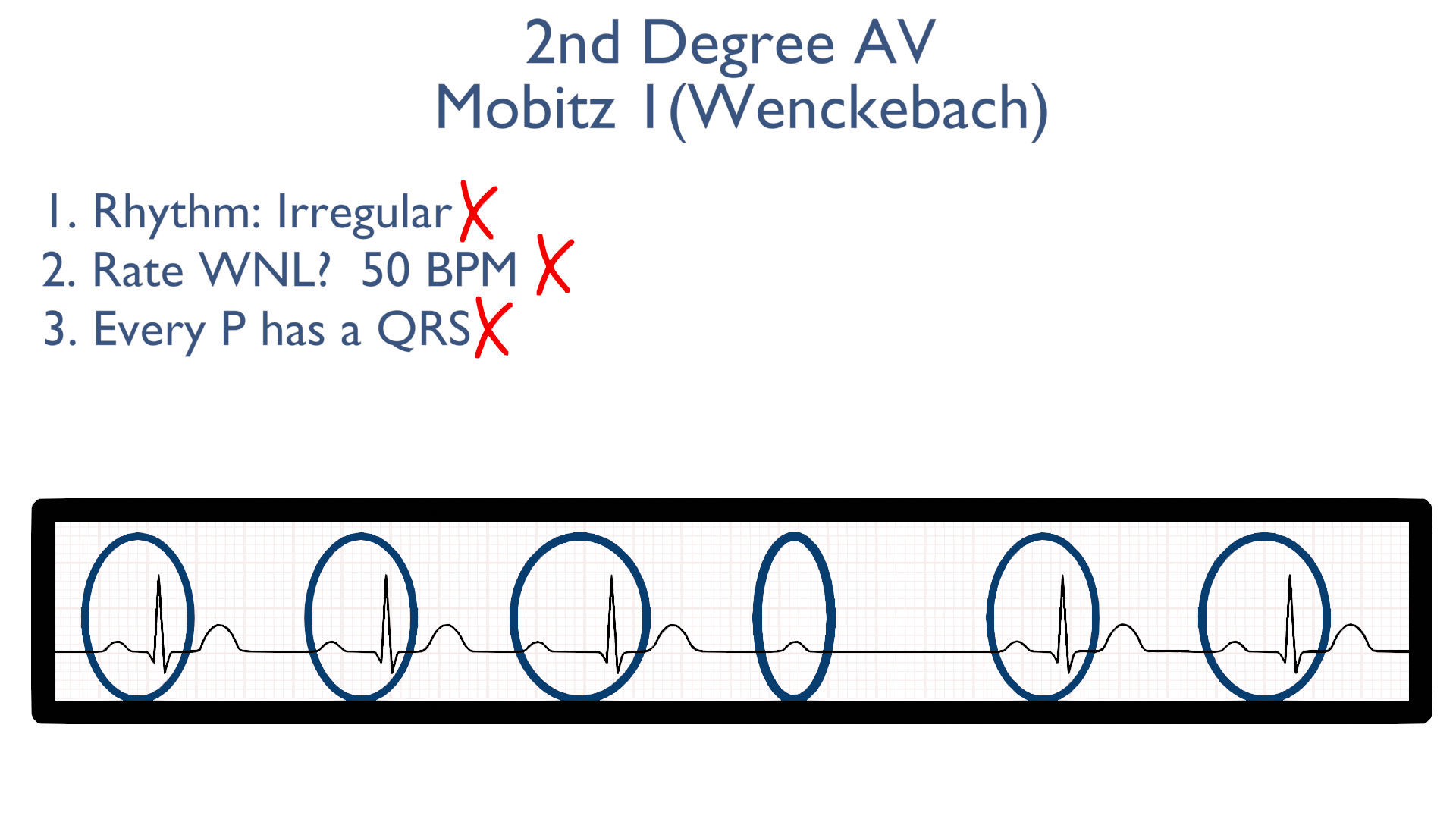 Type 2 AV Block Mobitz 1 (Wenckebach) – Nursing Unraveled