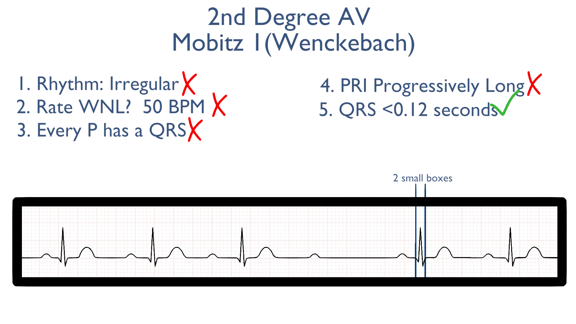 Type 2 AV Block Mobitz 1 (Wenckebach) – Nursing Unraveled
