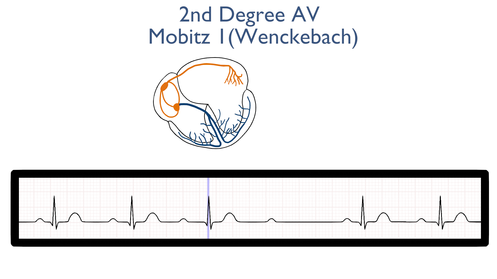 Type 2 AV Block Mobitz 1 (Wenckebach) – Nursing Unraveled