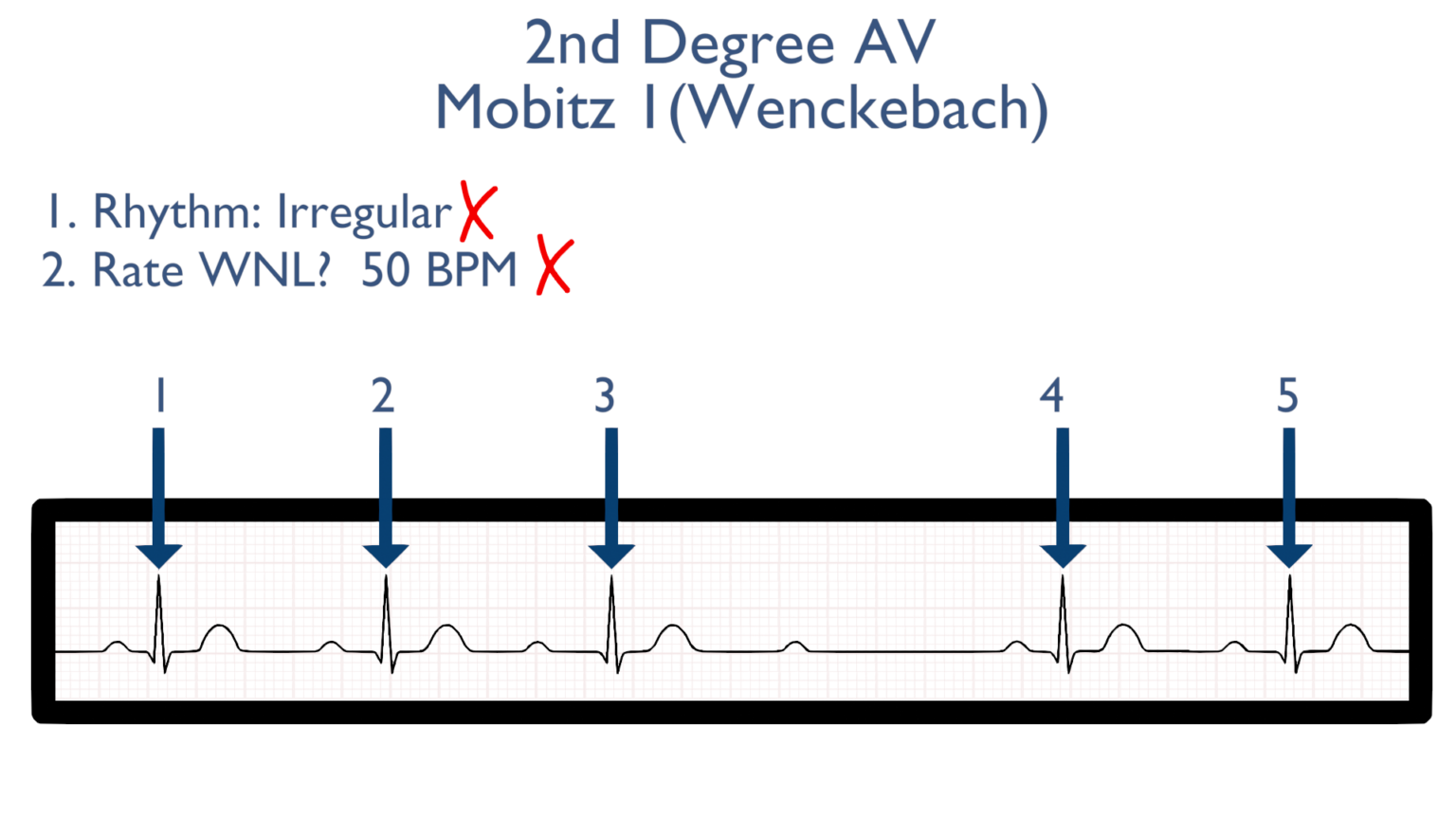 Type 2 AV Block Mobitz 1 (Wenckebach) – Nursing Unraveled