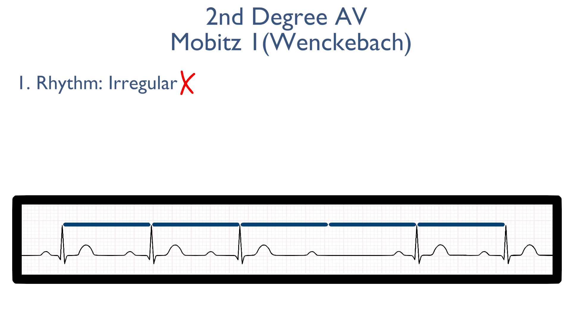 Type 2 AV Block Mobitz 1 (Wenckebach) – Nursing Unraveled