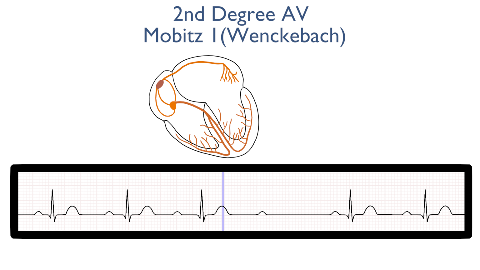 Type 2 AV Block Mobitz 1 (Wenckebach) – Nursing Unraveled