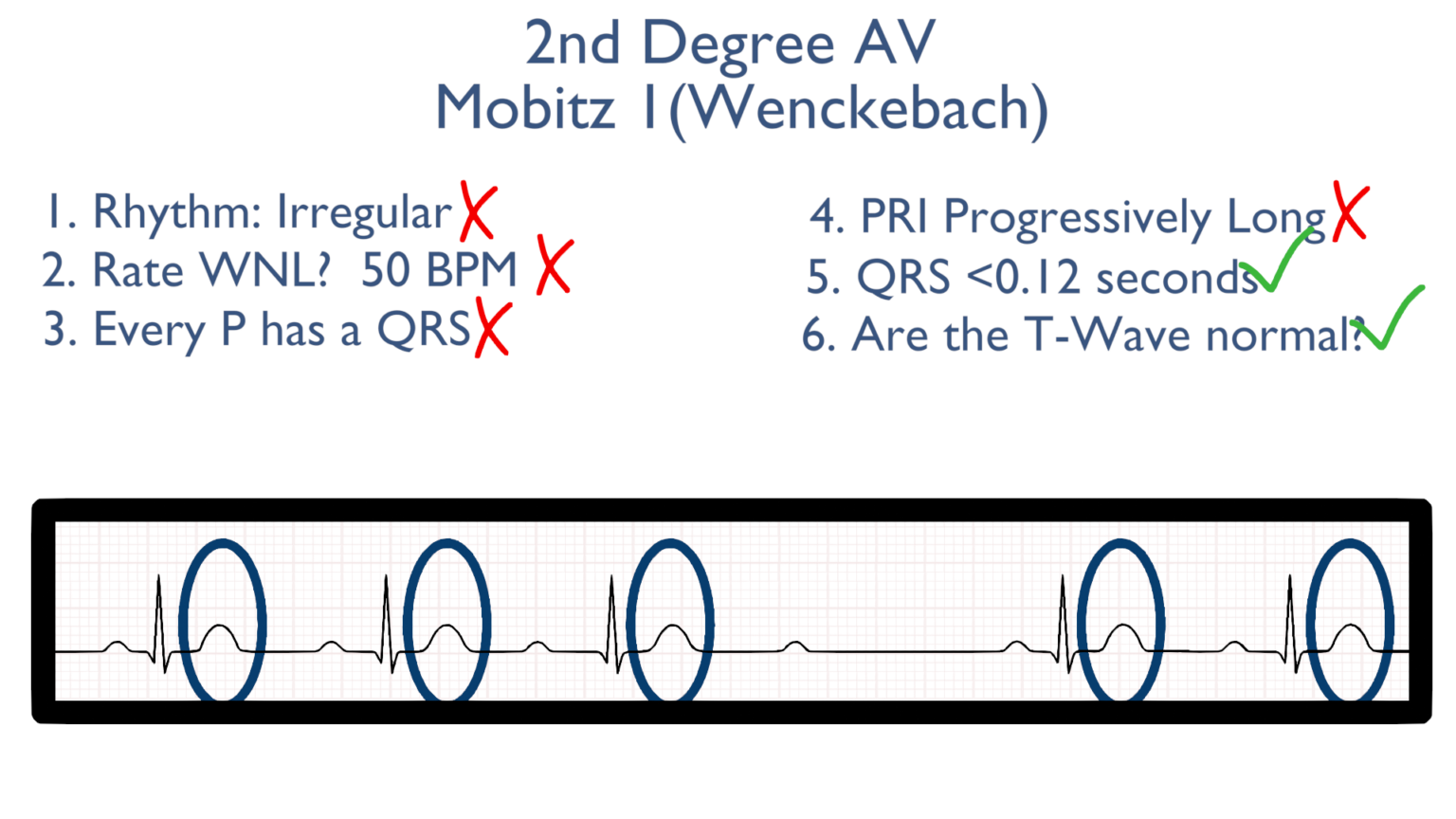 Type 2 AV Block Mobitz 1 (Wenckebach) – Nursing Unraveled