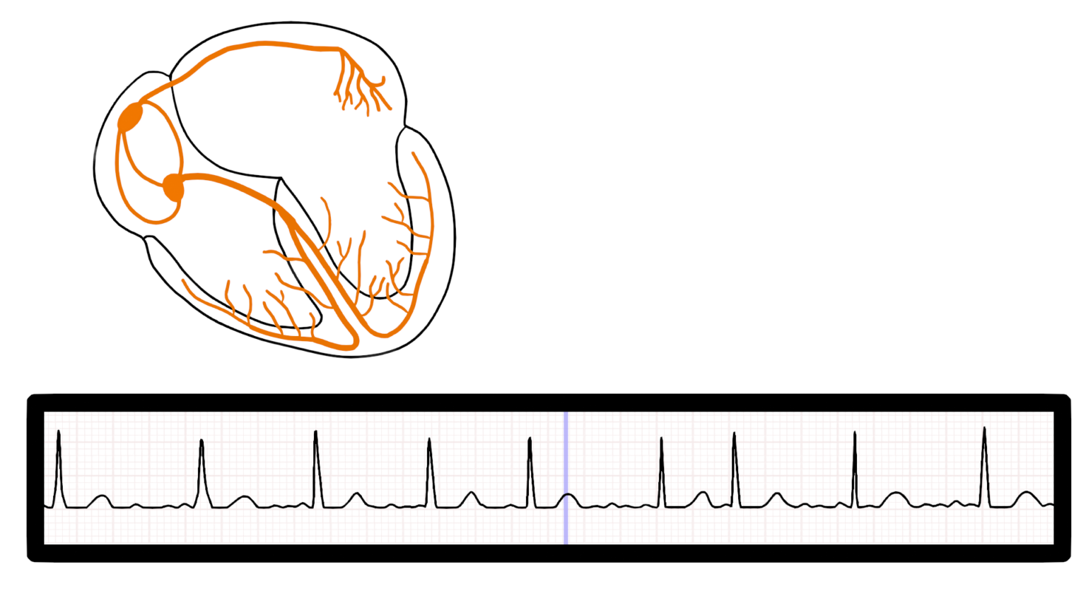 Atrial Fibrillation (AF) – Nursing Unraveled