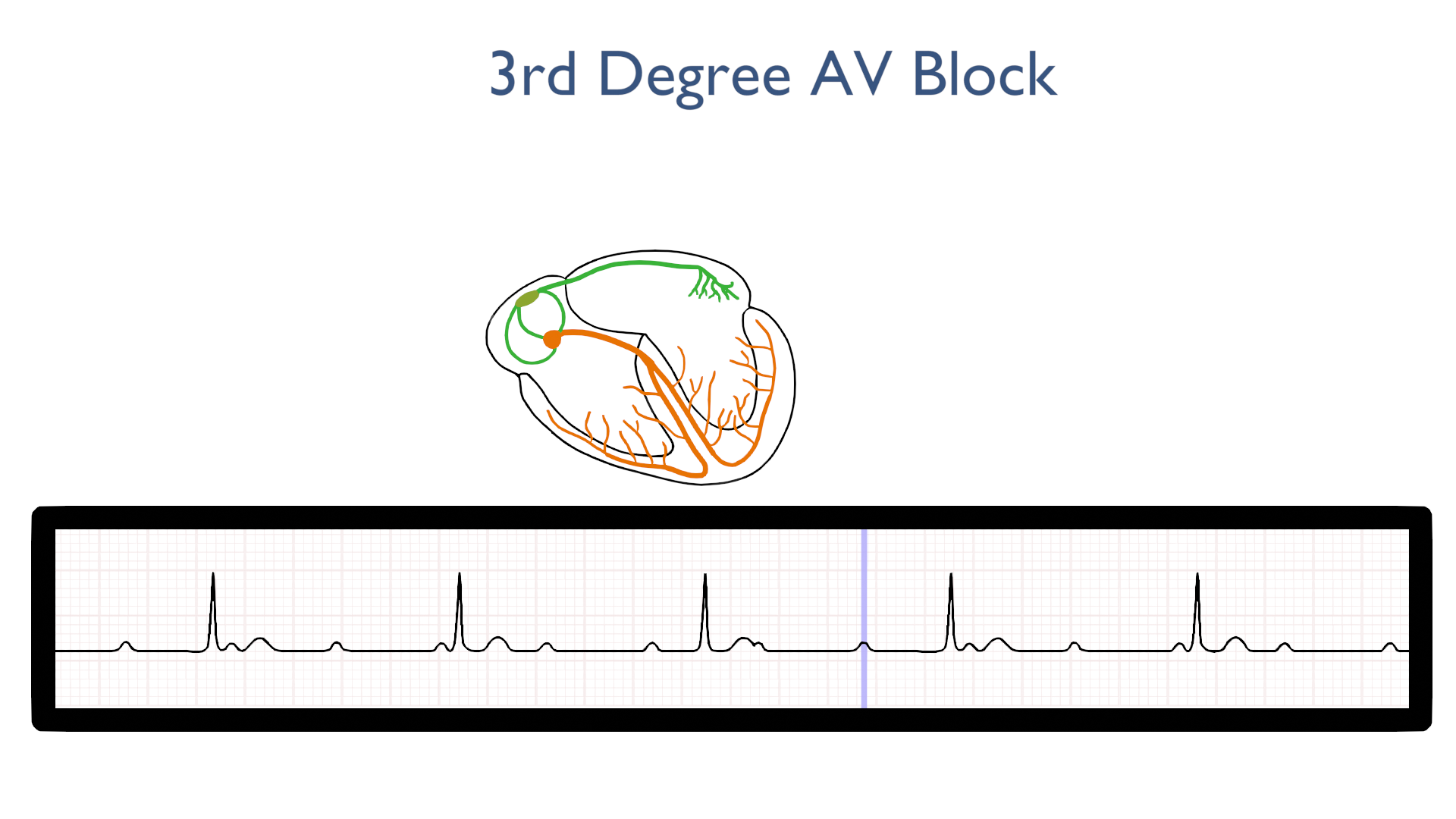 3rd Degree AV Block – Nursing Unraveled